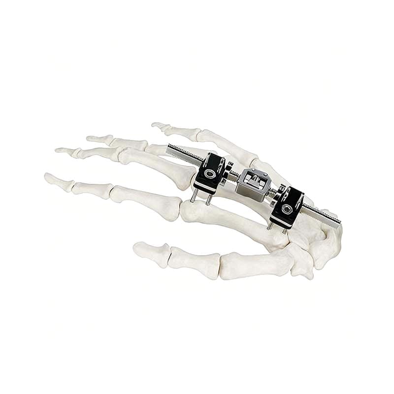 Mini Fixator Joint Motion Type – Lightweight External Fixator for ...